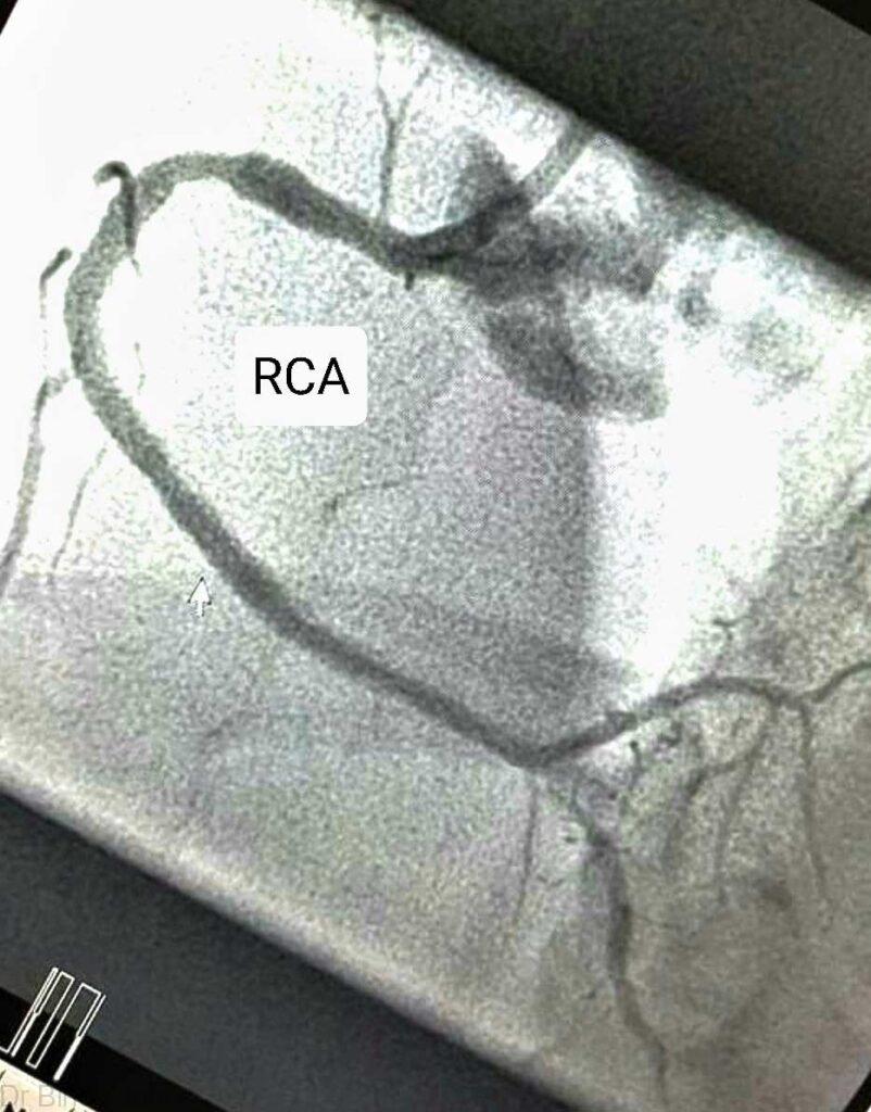 Coronary Angiogram – Dr Binoy John